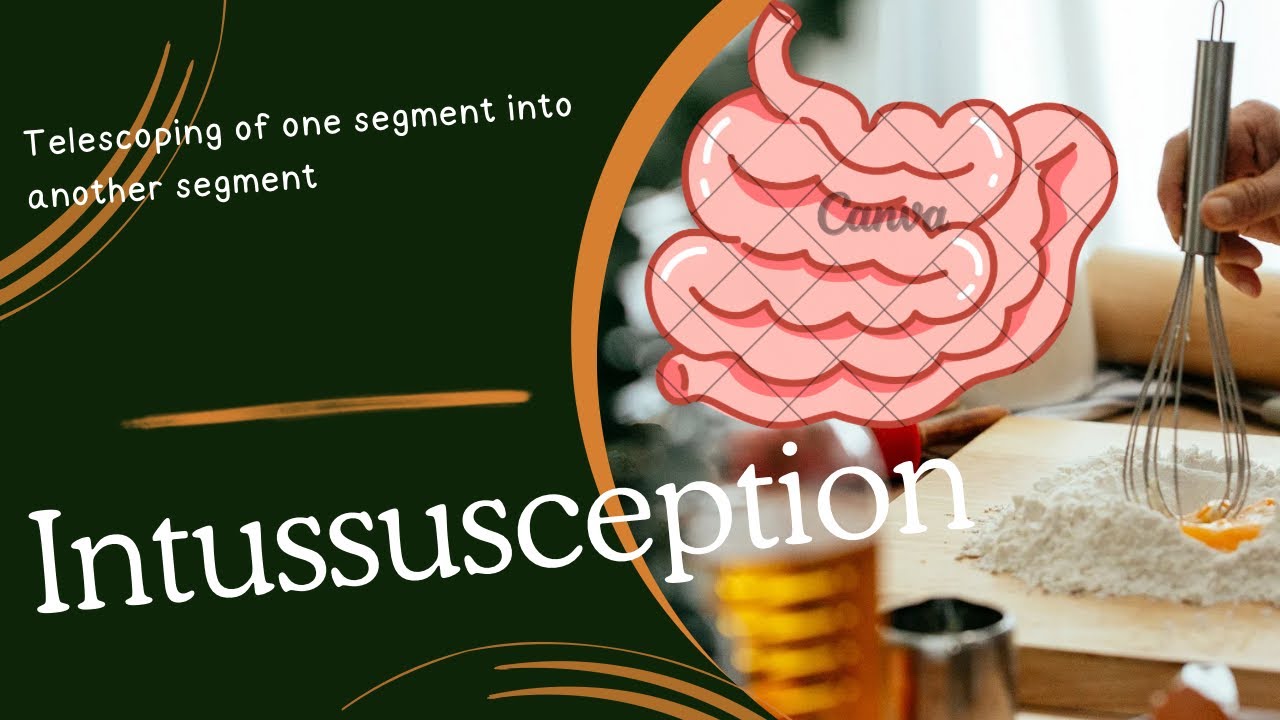 INTUSSUSCEPTION || INTESTINE || INTESTINAL OBSTRCTION || RED CURRANT ...