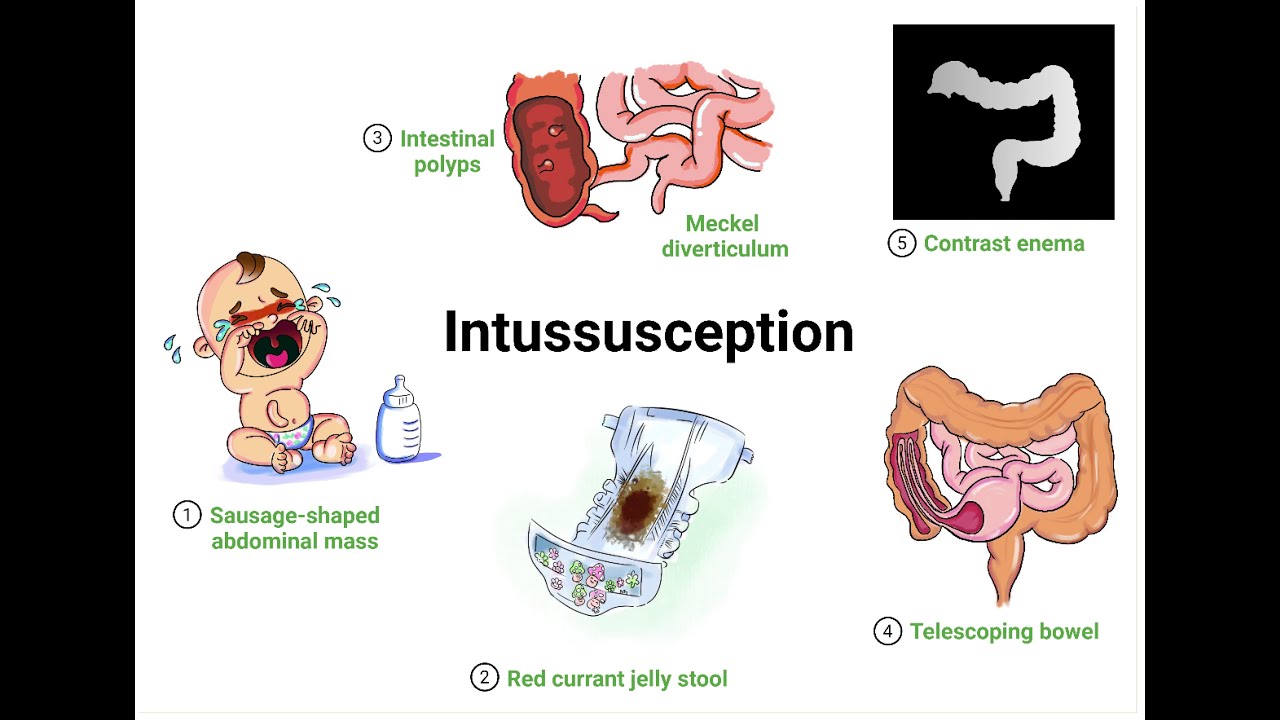 Currant jelly stool ; Seen in Intussusuception Patients, Symptoms, How ...