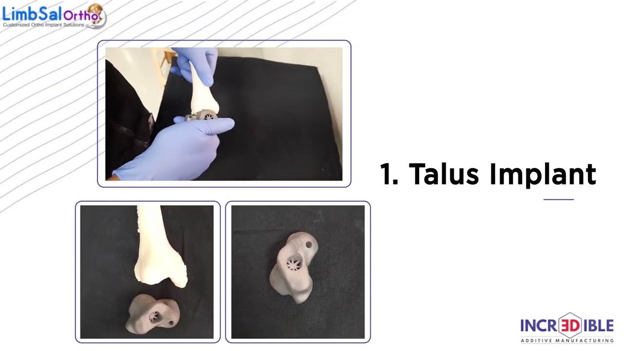 3D printed patient specific Orthopaedic Implants by 3D Incredible - YouTube