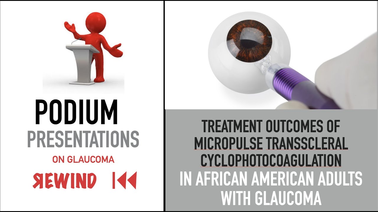 Podium Presentations on Glaucoma REWIND: Micropulse Transscleral ...