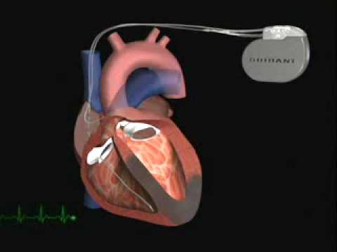 Funzionamento ICD - YouTube