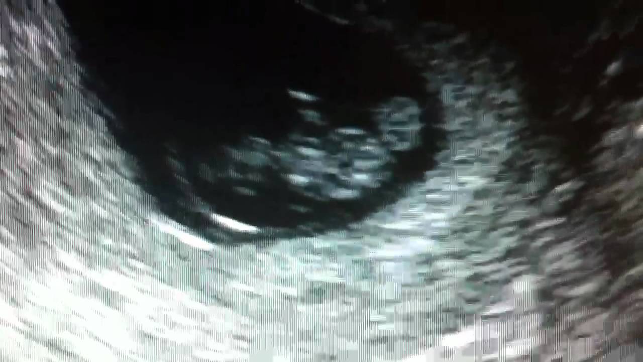 Sonogram at two months - YouTube