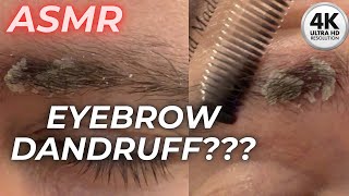 ASMR Eyebrow Dandruff Removal?! | Seborrheic Dermatitis Skin Flake Flare Up