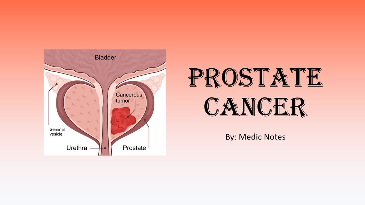 Prostate cancer - symptoms, investigations, Gleason scoring, treatment ...