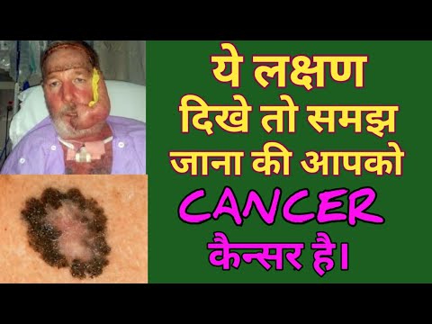 कैंसर के लक्षण । Cancer symptoms in hindi ! - YouTube