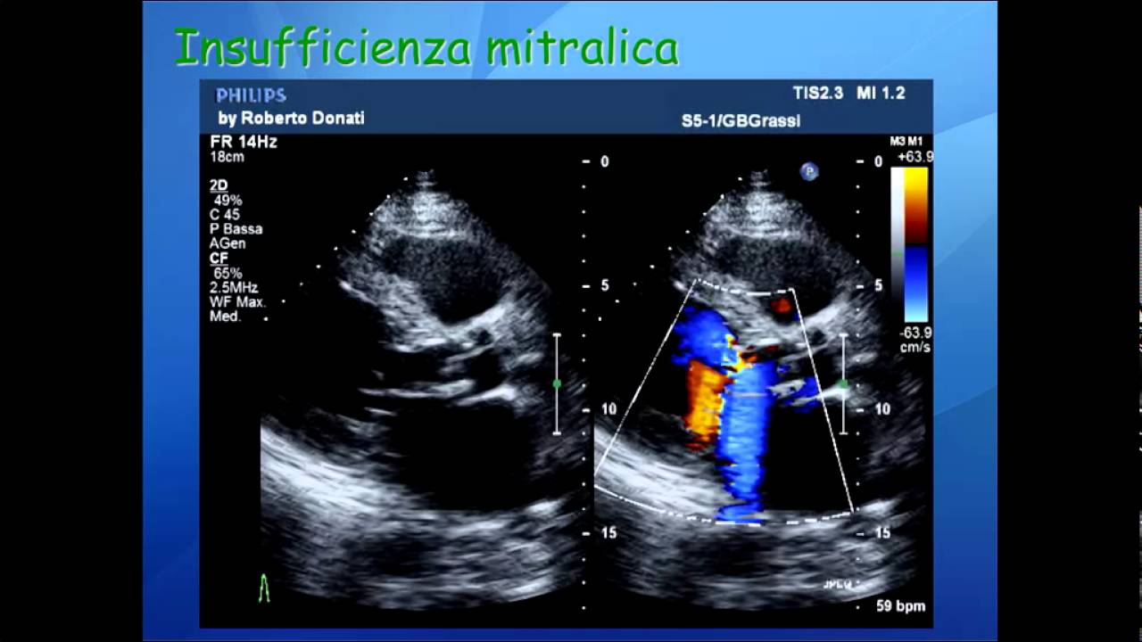 Elementi di ecocardiografia: VIII video, valvulopatia mitralica. - YouTube