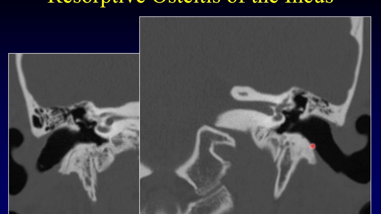 Temporal Bone Pathology 7: Hearing Loss Part 2 - YouTube