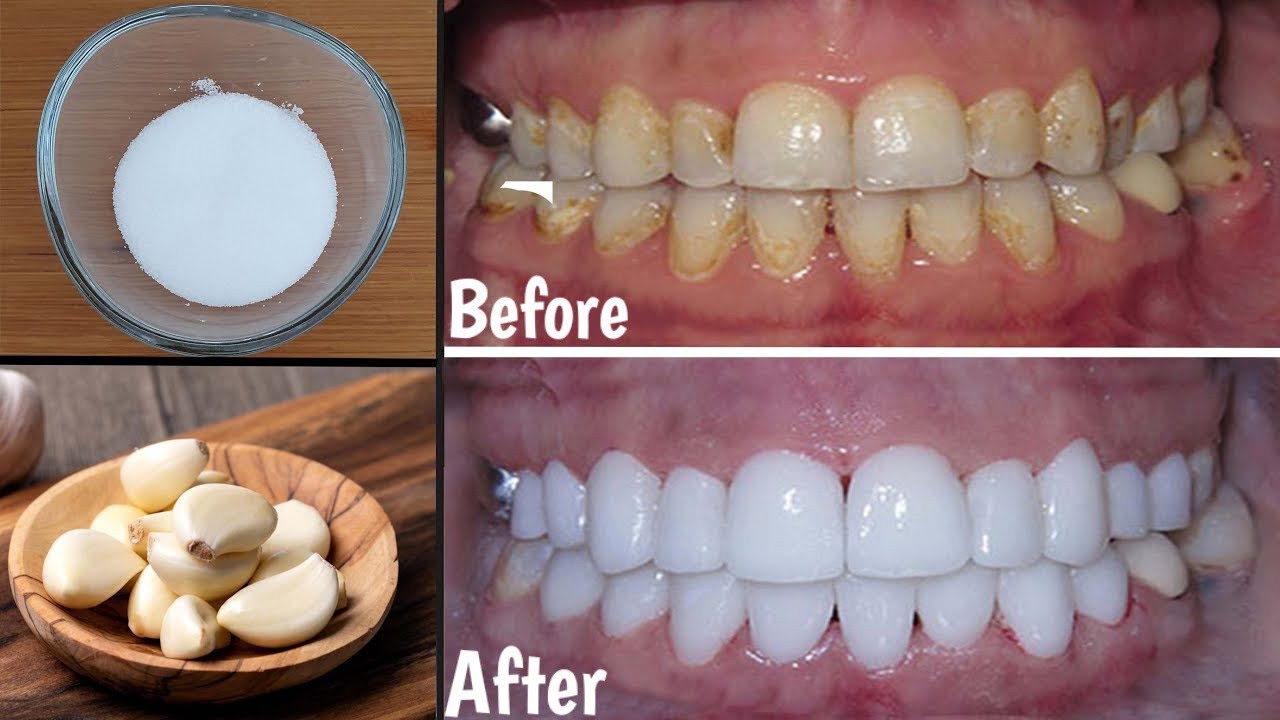 Teeth whitening at home in 3 minutes || How to naturally whiten your ...