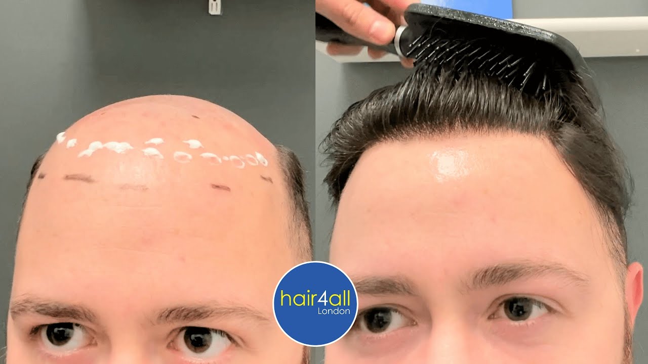 Close Up & Natural Looking Hair System | Non-Surgical Hair Replacement ...