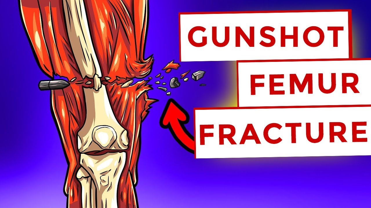Femur Fracture |Gunshot injury| - YouTube