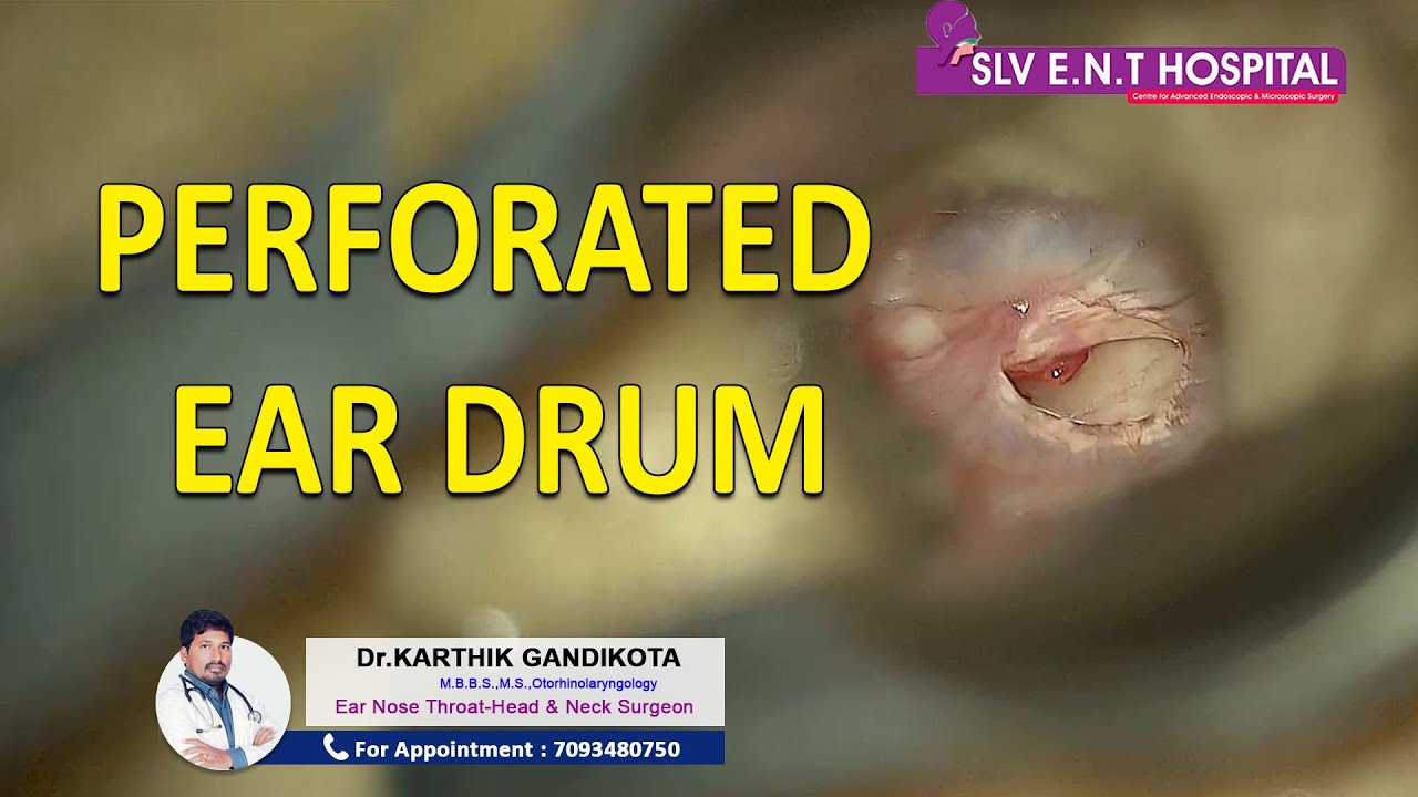 PERFORATED EAR DRUM YouTube