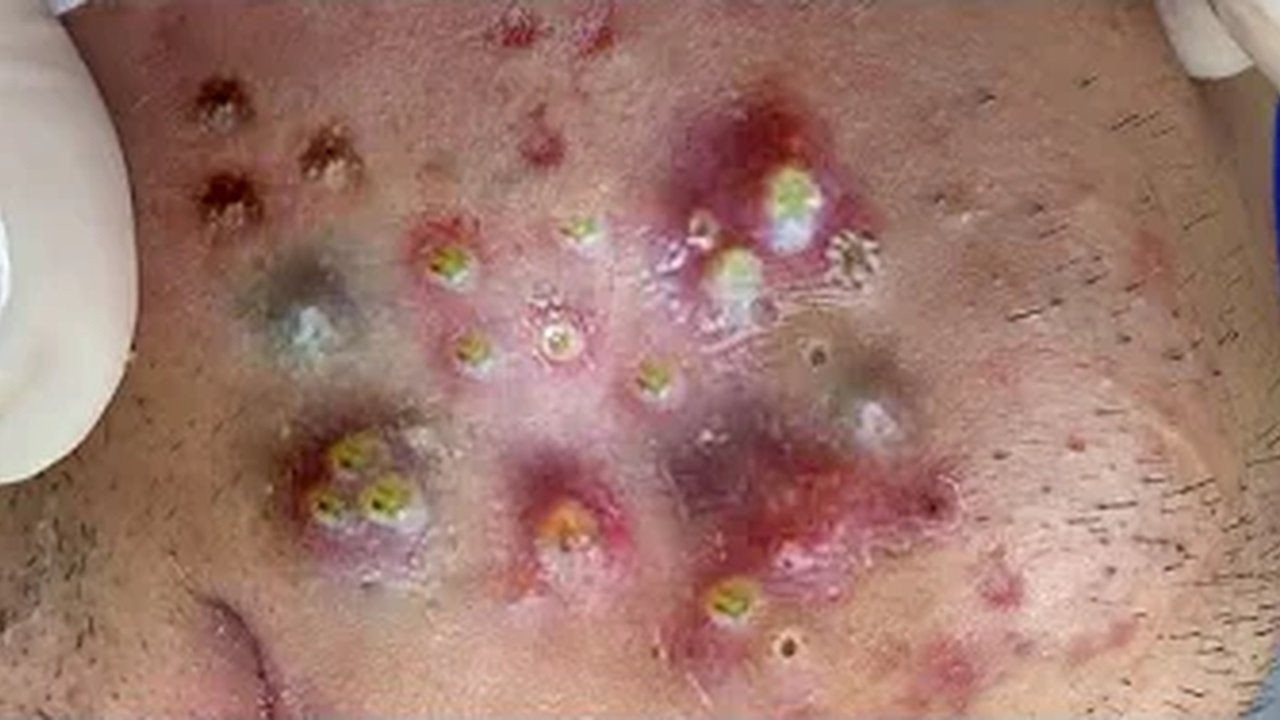 Giant Blackhead Extraction: Watch This Satisfying Pore Cleaning! 😱🔍 ...