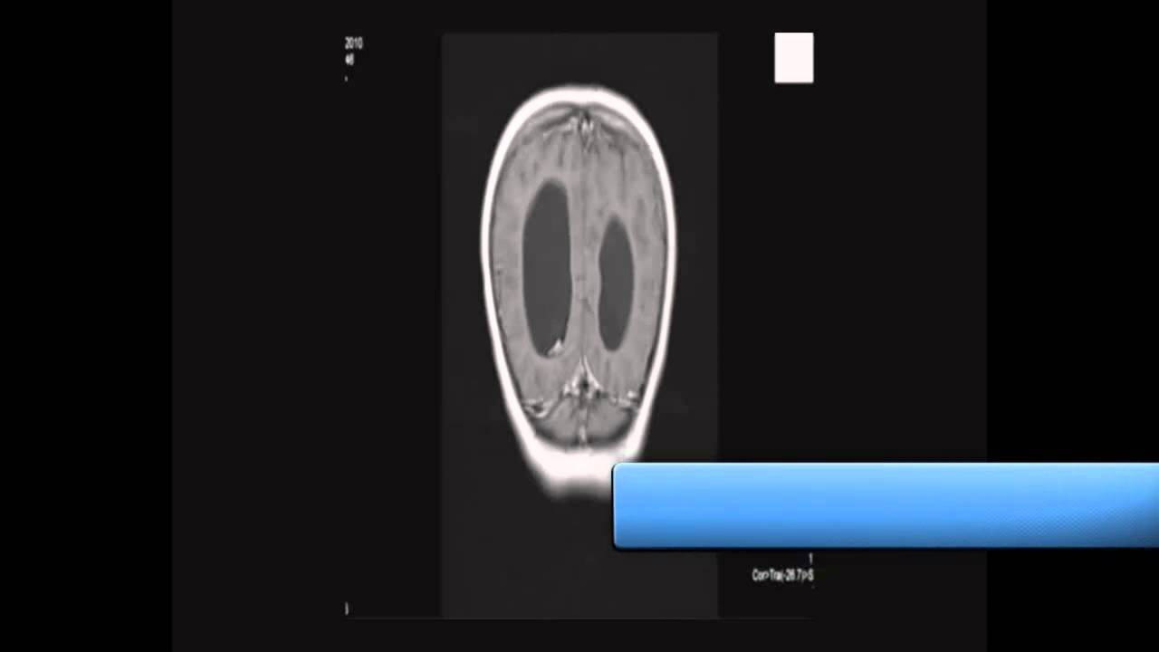074 Colpocefalia, uma das causas raras de atraso escolar. - YouTube