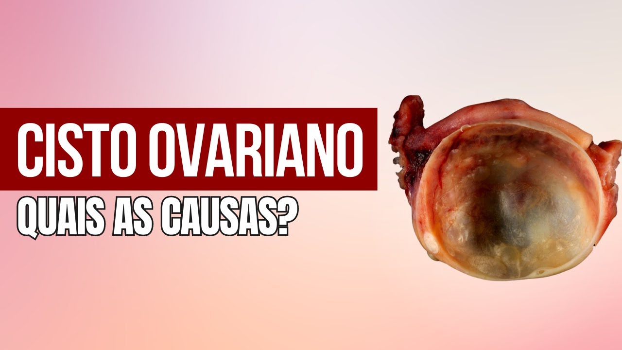 Quais as causas para cisto no ovário? - YouTube