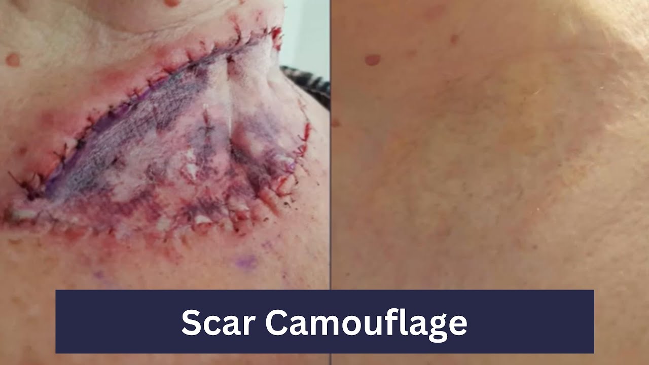 Life Changing Scar Camouflage Micropigmentation Treatment - YouTube