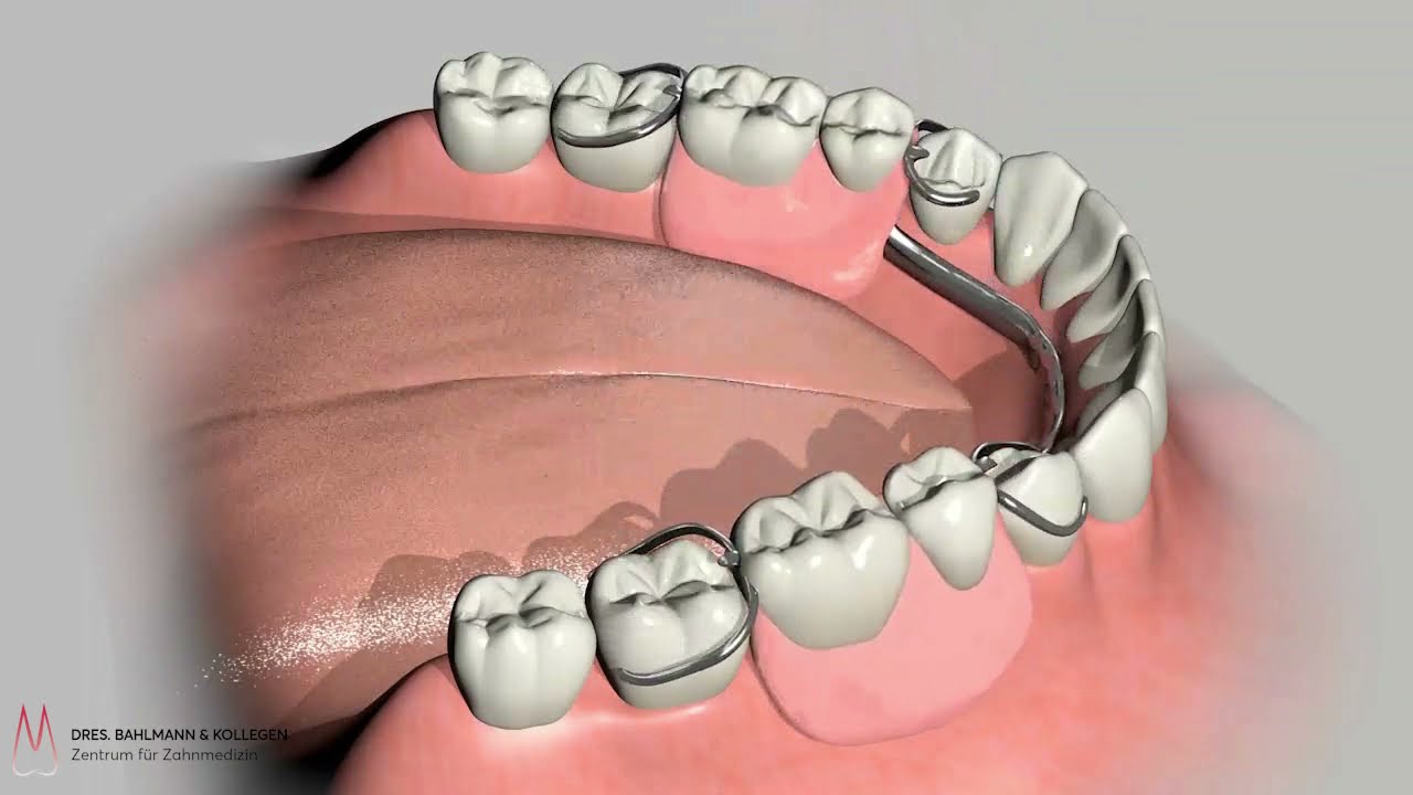 Was ist eine Modellgußprothese - Einfach erklärt - YouTube