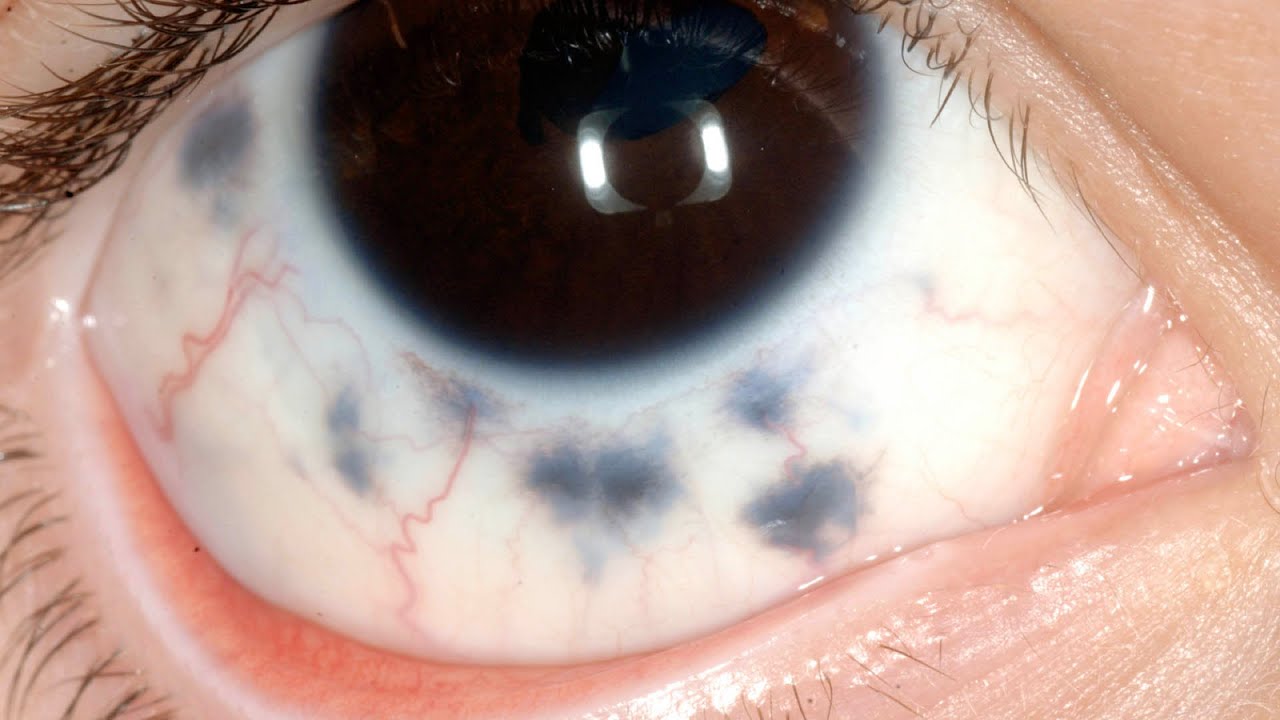 Pigmented Conjunctival Lesions Dr Ralph Eagle - YouTube