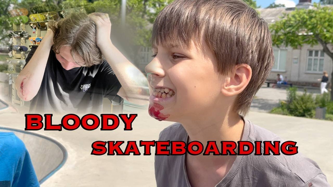 SMASHED FACE IN ON SKATEBOARD?! BLOODY SKATEBORDIG - YouTube