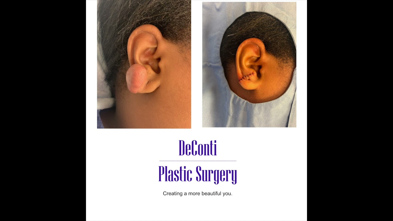 Ear Keloid Scar removal - YouTube