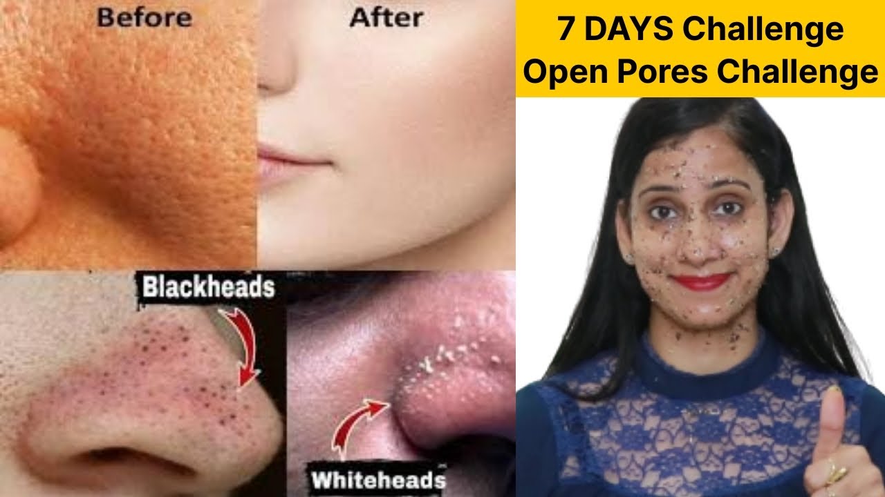 कितने भी पुराने OPEN PORES, LARGE PORES, CLOGGED PORES हों, इस Remedy ...