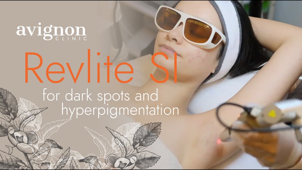 Avignon Brightening Laser Focuses on the Underarms - YouTube