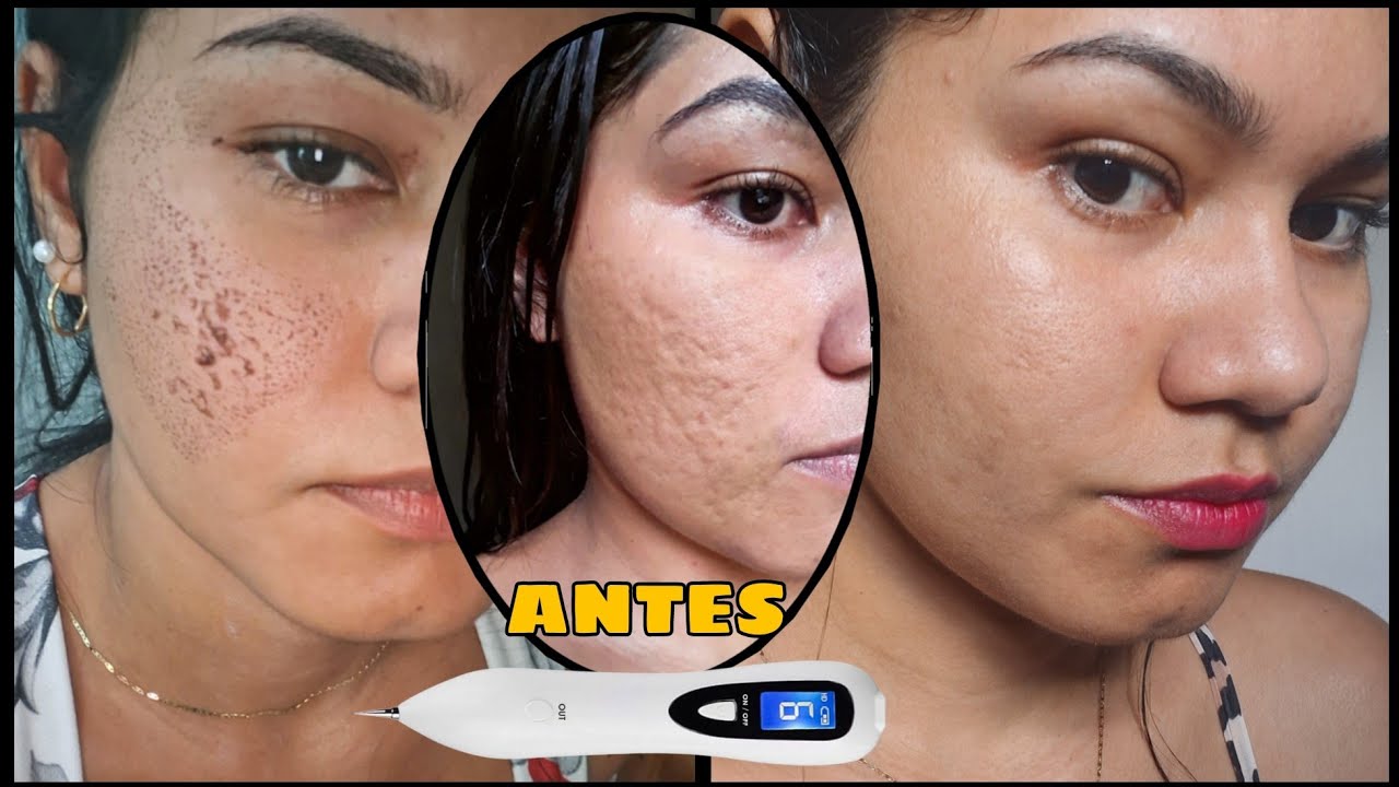 ANTES E DEPOIS CICATRIZES DE ACNE -Dermaroller e jato de plasma ...