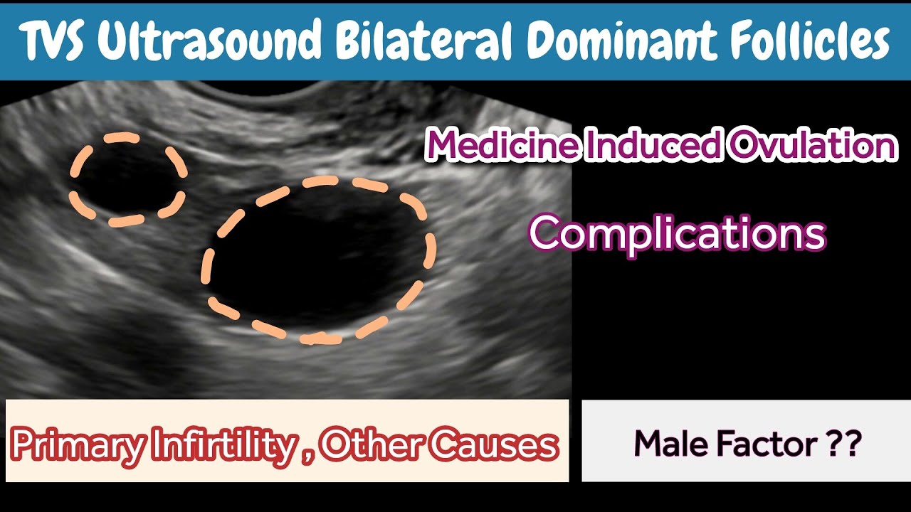 Medicine Induced Bilateral Dominant Follicles TVS | Primary Infirtility ...