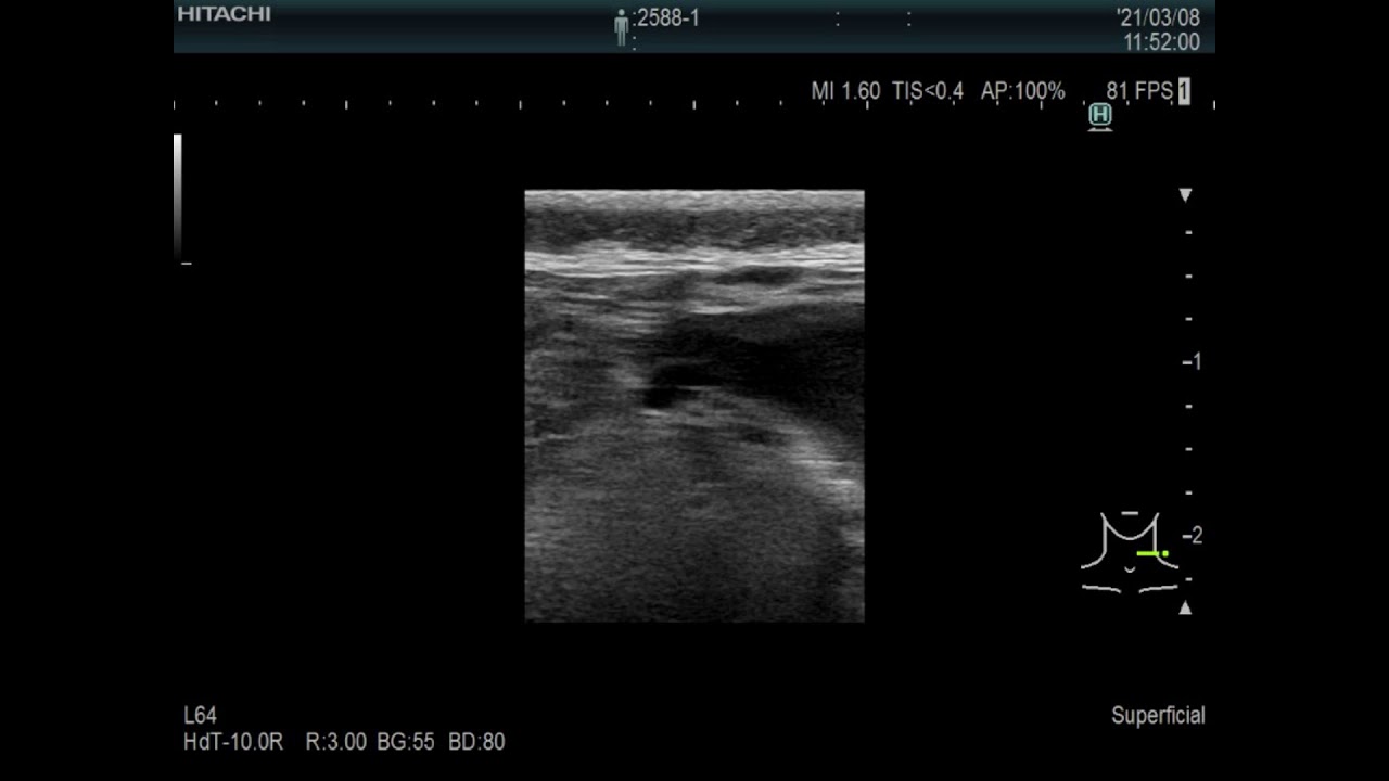 Echo image of the ranula in a dog(犬のガマ腫のエコー） - YouTube