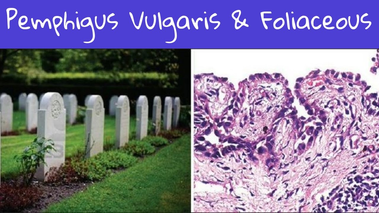 Pemphigus Vulgaris & pemphigus foliaceous #pathology lectures # ...