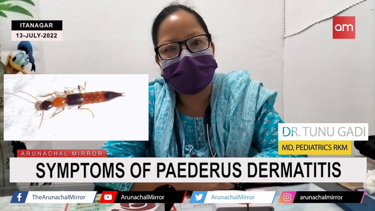 Symptoms of Paederus Dermatitis. - YouTube