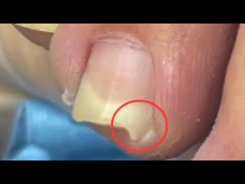 Toenail corners are full of dirt due to lack of cleaning for long time ...
