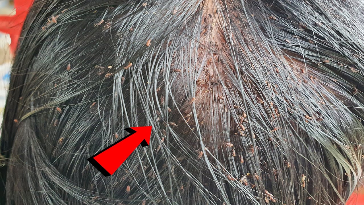 Daily lice combing - Extremely damaged Big lice removal on long hair ...
