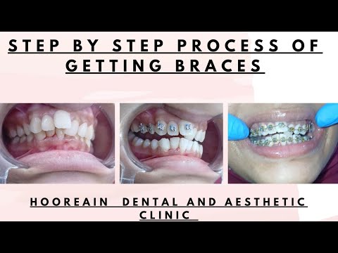 Braces Complete Procedure [Easy Guidance]#braces #bracestreatment #easy ...