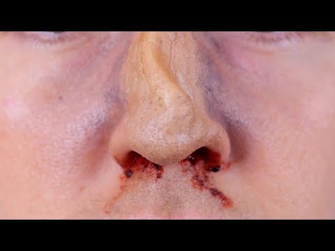 FRACTURED NOSE!