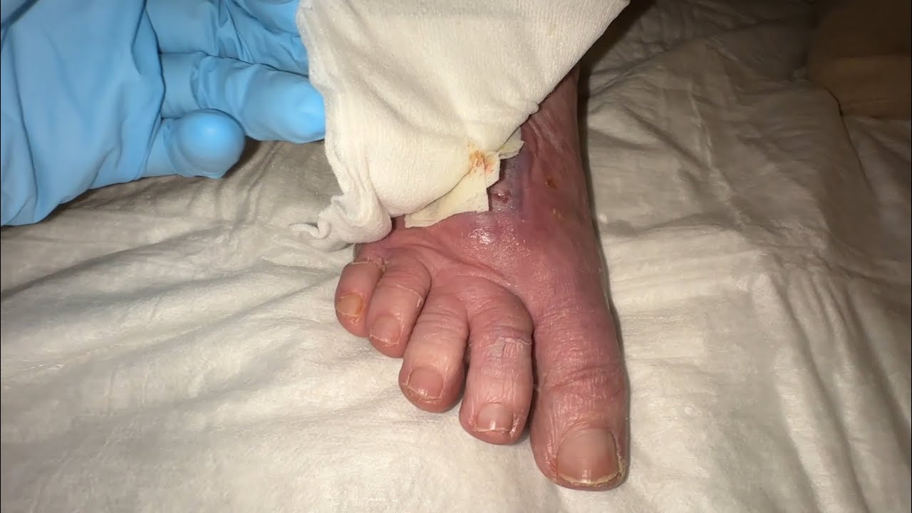 Infected Wound Care Cleaning & Dressing of Anterior Foot Venous Stasis ...