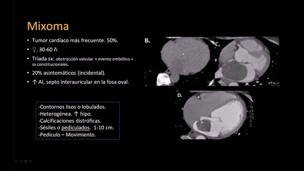 Radiología en 5 minutos: Mixoma. - YouTube