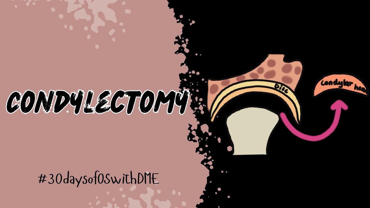 CONDYLECTOMY || TMJ ANKYLOSIS SURGICAL PROCEDURE || 30daysofOSwithDME ...