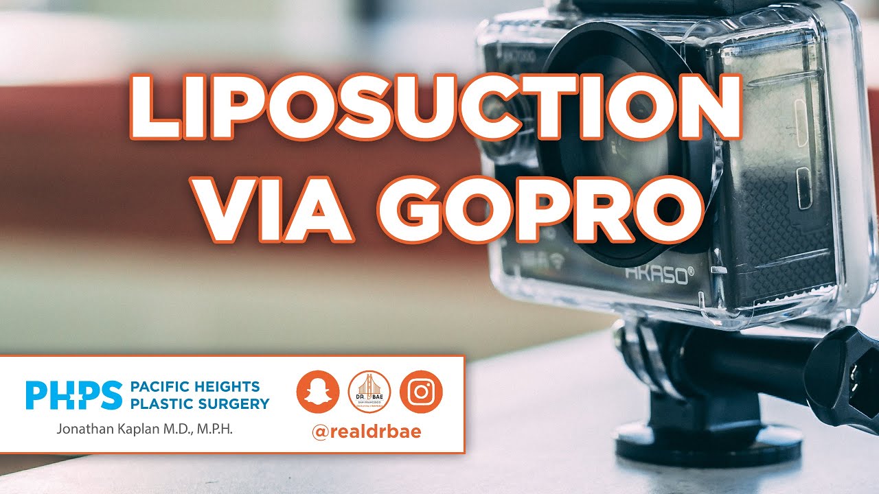 *GOPRO* Liposuction to the Lower Back | Pacific Heights Plastic Surgery ...