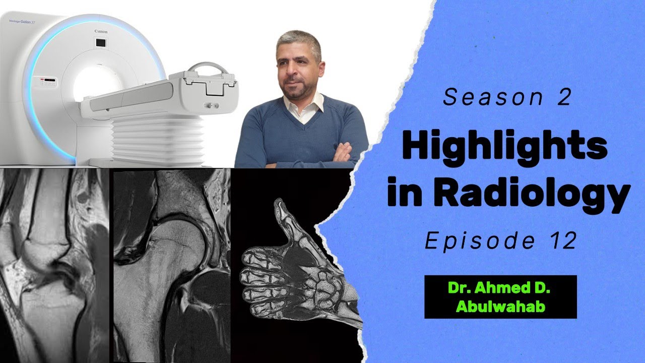 Highlights in Radiology, S2, E12, Giant cell tumor (GCT) - YouTube