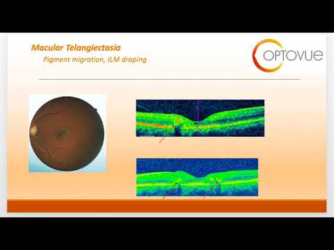 OCT Interpretation Session 10 Macular Telangiectasia - YouTube