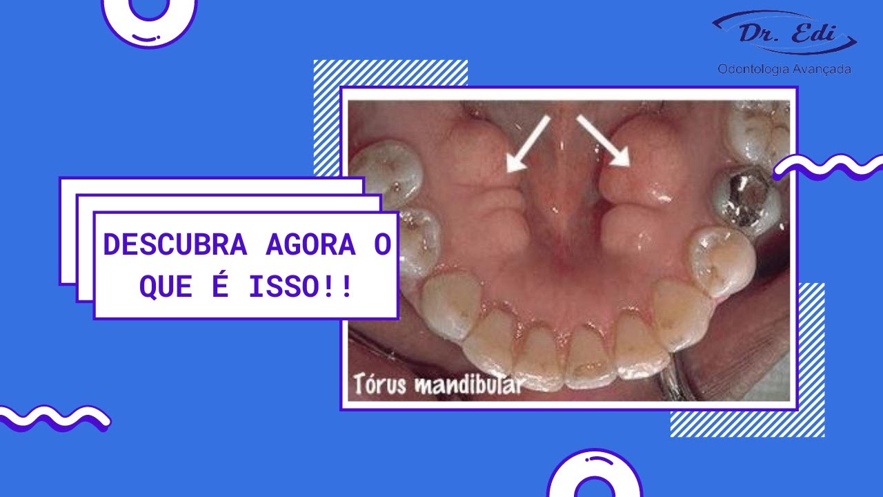 Tórus mandibular e palatino: o que é? existe algum tratamento? - YouTube