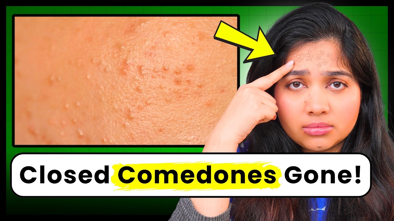 How I Finally Cleared My Closed Comedones & Clogged Pores! - YouTube