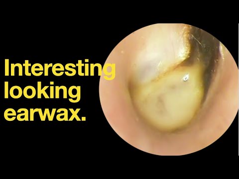 Interesting looking earwax. |ear wax removal | ear cleaning | ASMR ...