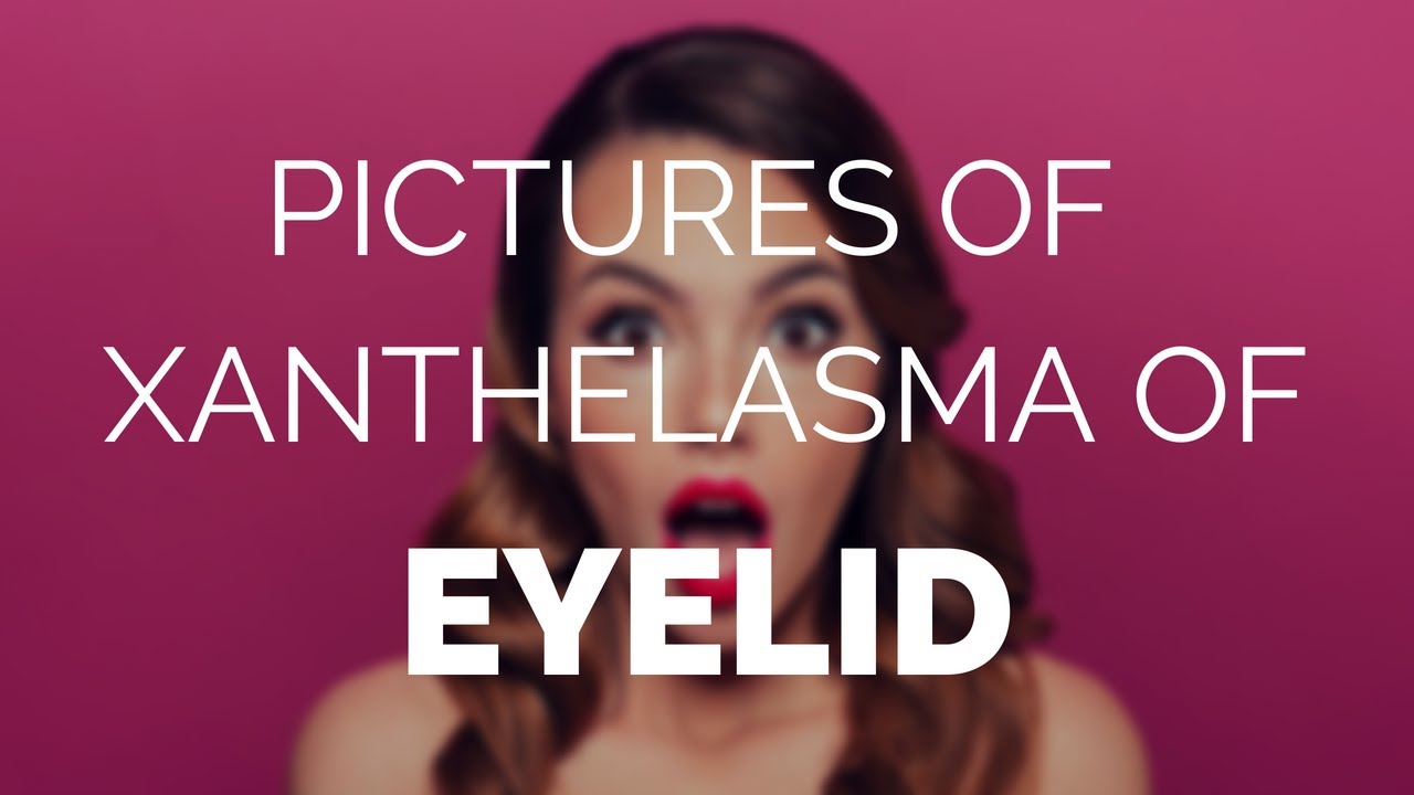 Pictures of xanthelasma of eyelid and Xanthoma at Xanthel.com - YouTube