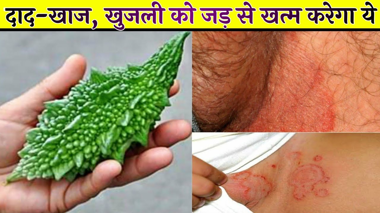 दाद खाज खुजली कि 7 दिन में छुट्टी कर देगा | fungal infection treatment ...