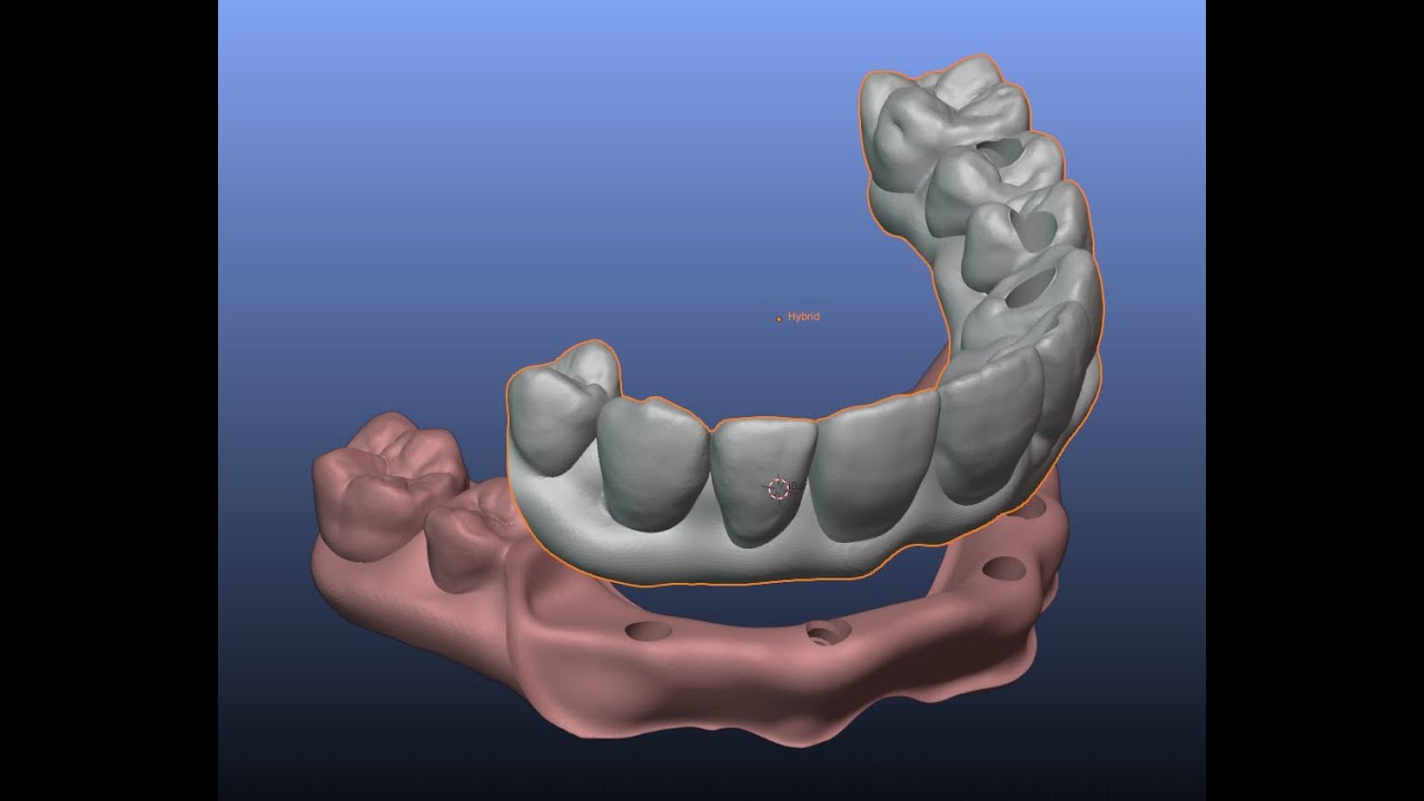 iBar with distal metallic canti-lever extension. - YouTube