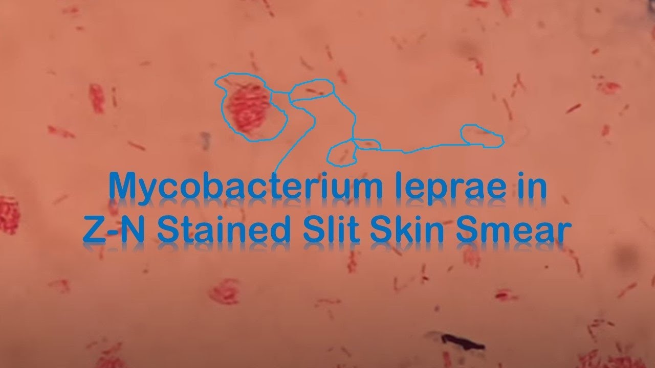 Mycobacterium leprae in Ziehl-Neelsen stained Slit skin smear - YouTube