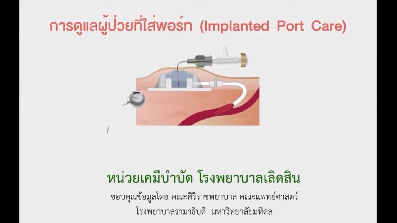 การดูแลผู้ป่วยที่ใส่พอร์ท (Implanted Port Care) - YouTube