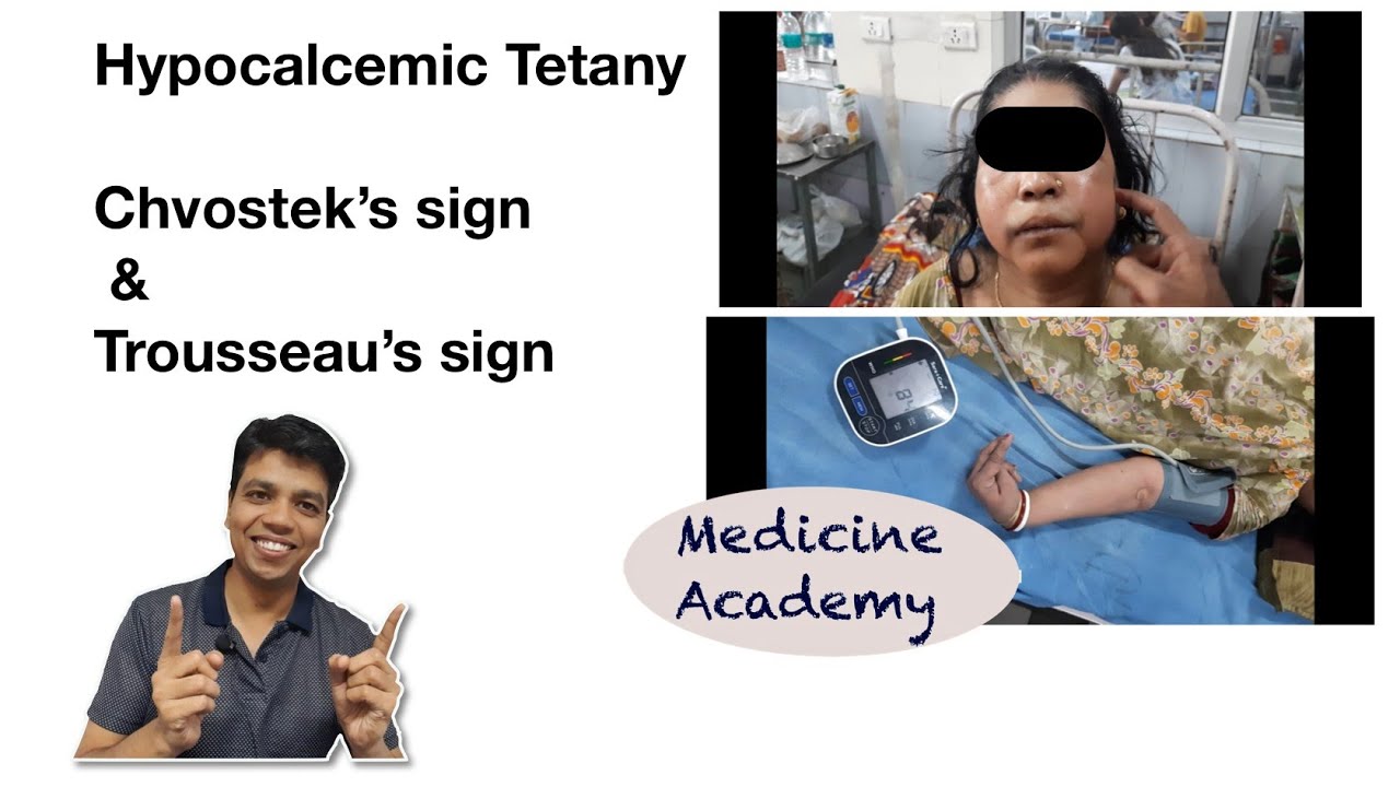 Hypocalcemic Tetany signs #Chvostek's sign #Trousseau's sign - YouTube