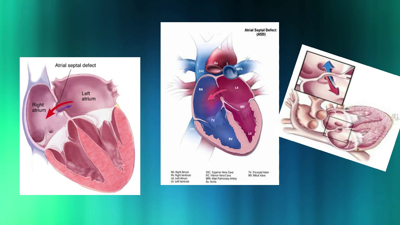Atrial Septal Defect - YouTube